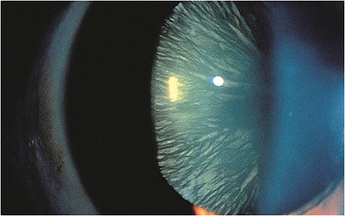 Presbyopia Physician | PentaVision