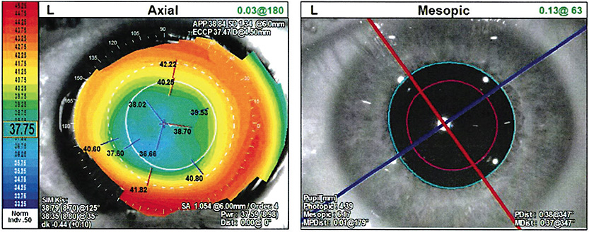 Presbyopia Physician | PentaVision